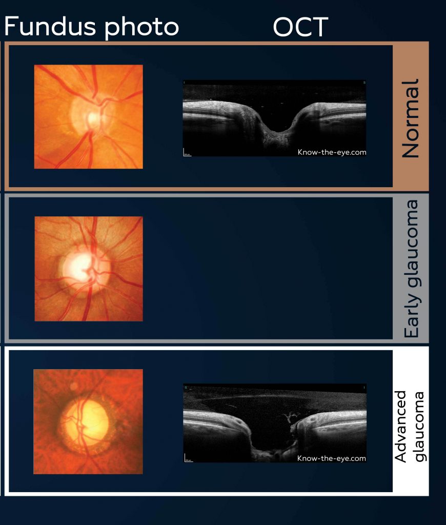 Glaucoma | Kala Motia | Best Eye Hospital in Pakistan